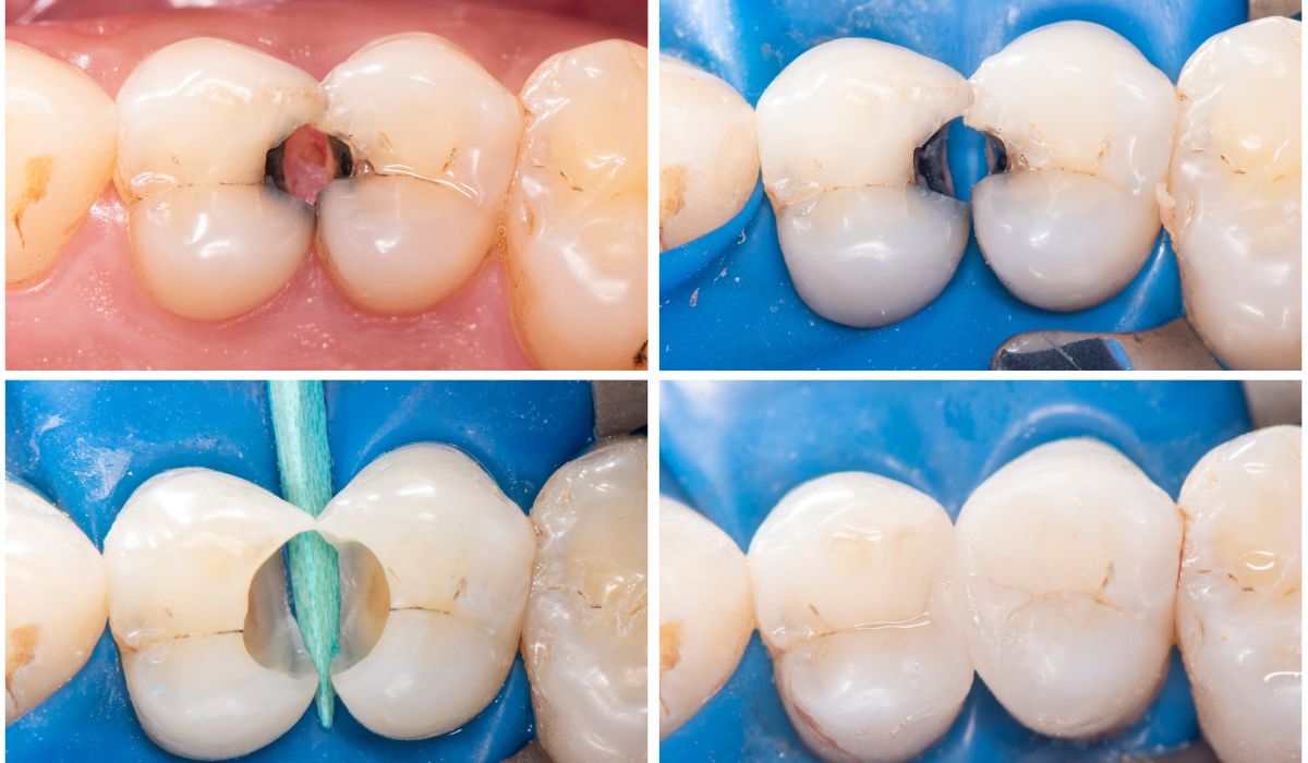Esthetic White Fillings – Shandental.com